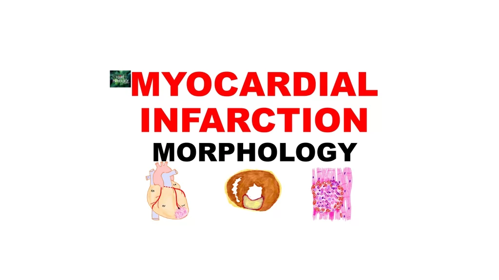 Myocardial Infarction: Gross and Microscopy - Pathology Made Simple